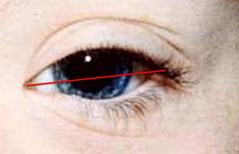 Signs – Iris – Spots – Clinical Eye Openers