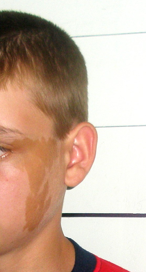 Café-au-Lait Patch Face – Clinical Eye Openers