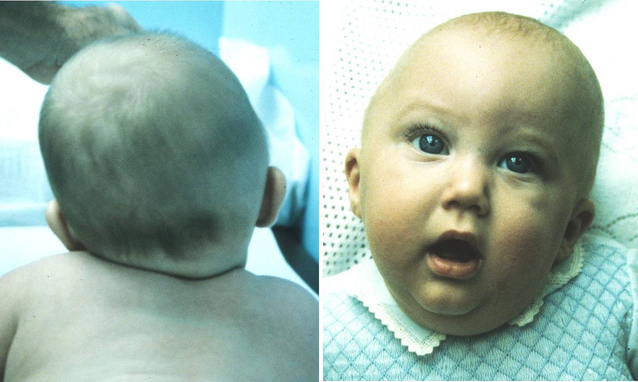 Torticollis – Plagiocephaly – Clinical Eye Openers