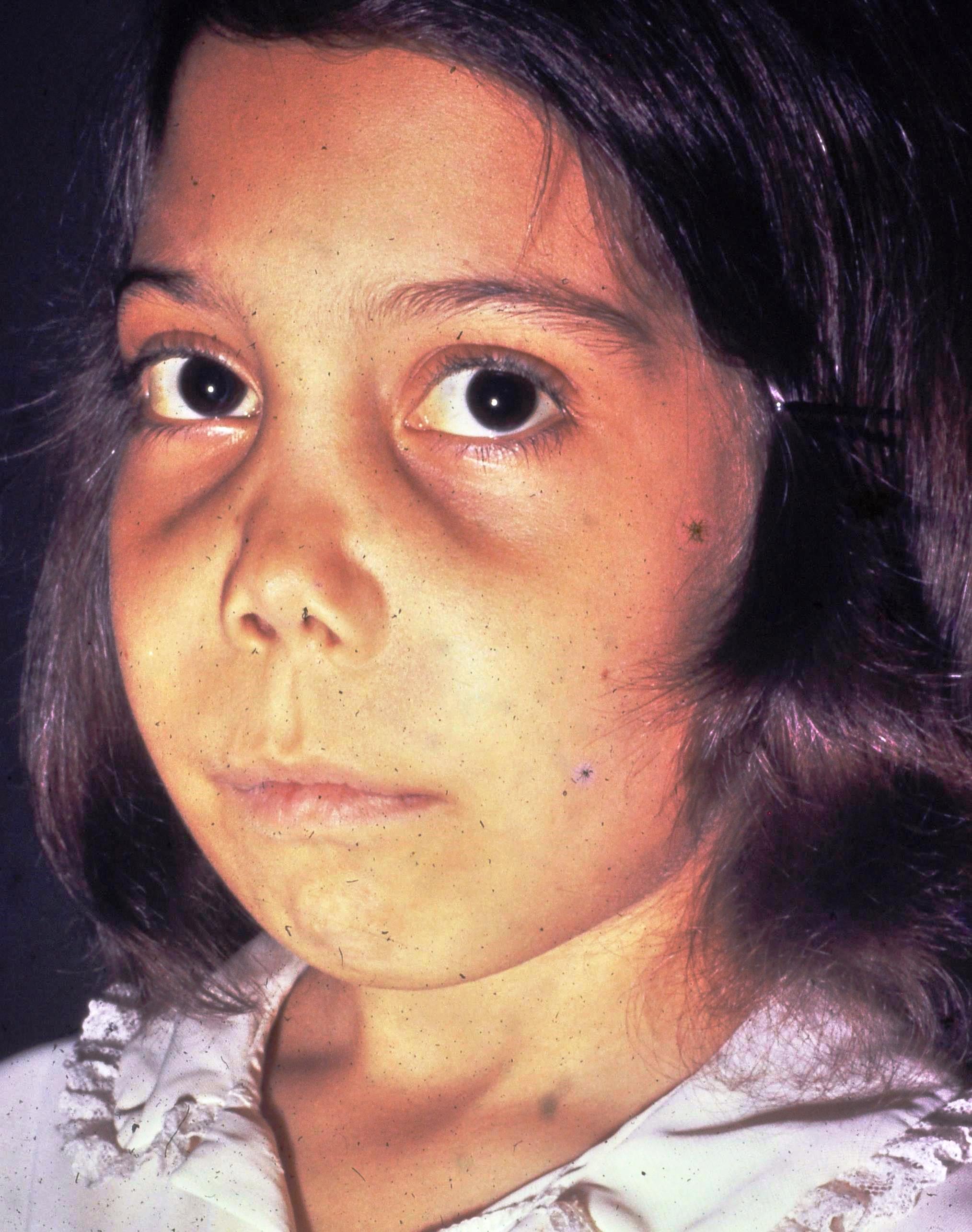 Facies Hematopoiesis – Clinical Eye Openers