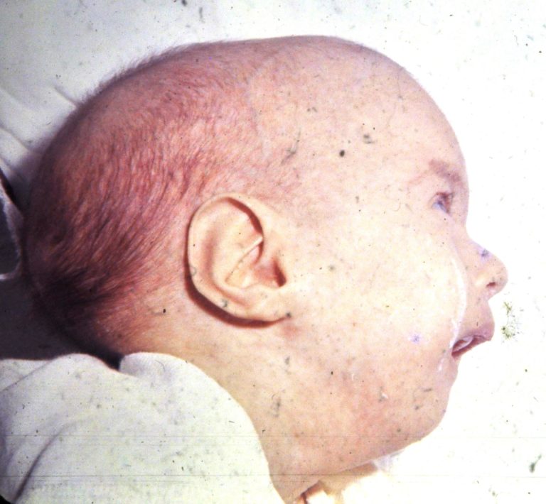 Edward Syndrome Profile 1a – Clinical Eye Openers