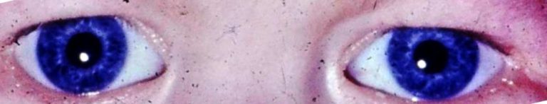 Facies Williams 1 – Clinical Eye Openers