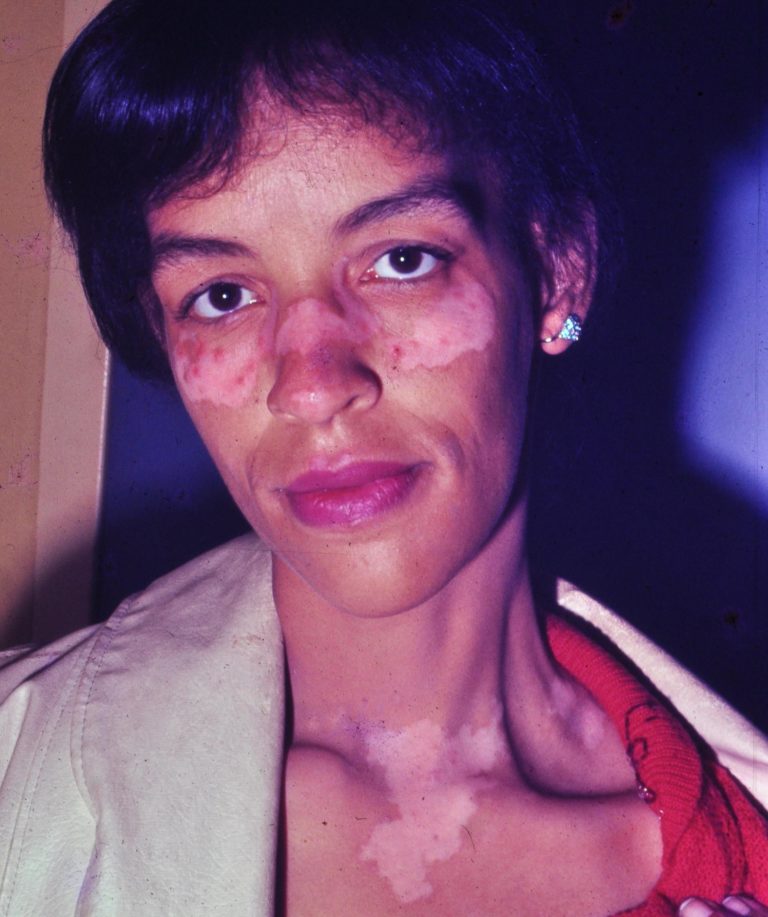 Malar Rash 1 – Clinical Eye Openers