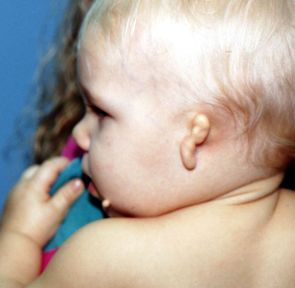 Ear Auricle Microtia and Ear Tag – Clinical Eye Openers