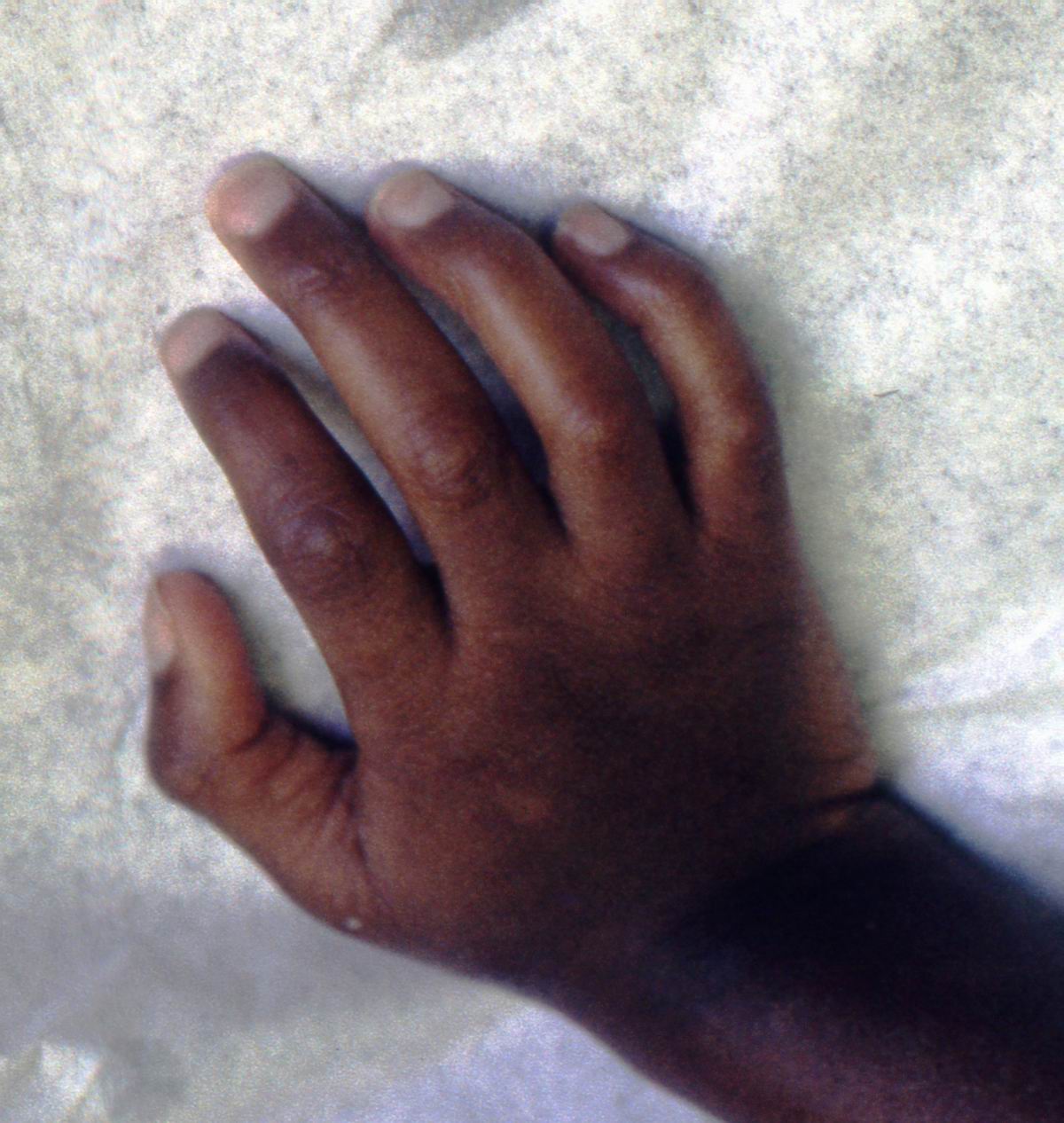 Hand Digit Fingers Dysmorphic – Clinical Eye Openers