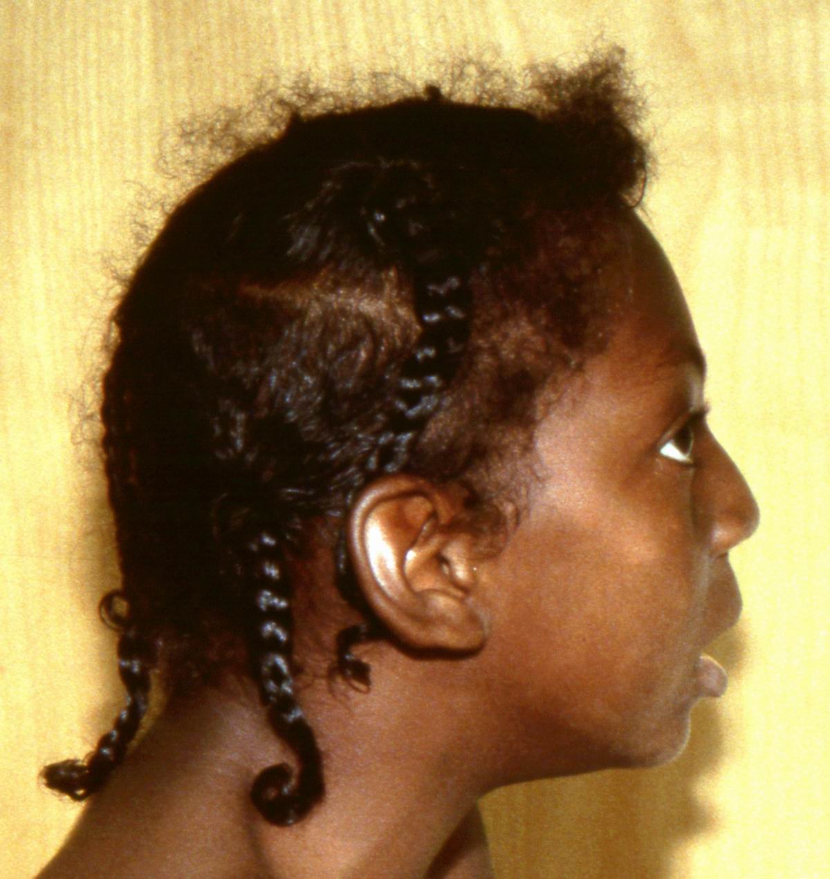 Microcephaly B – Clinical Eye Openers