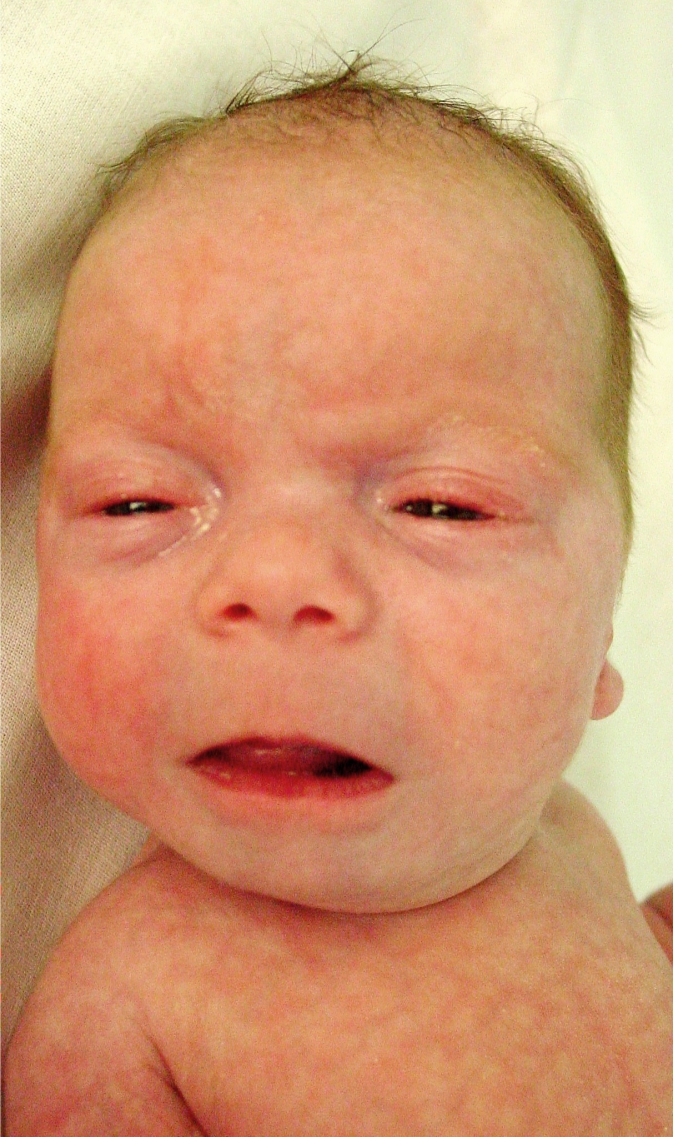 FAS Facies ? – Clinical Eye Openers