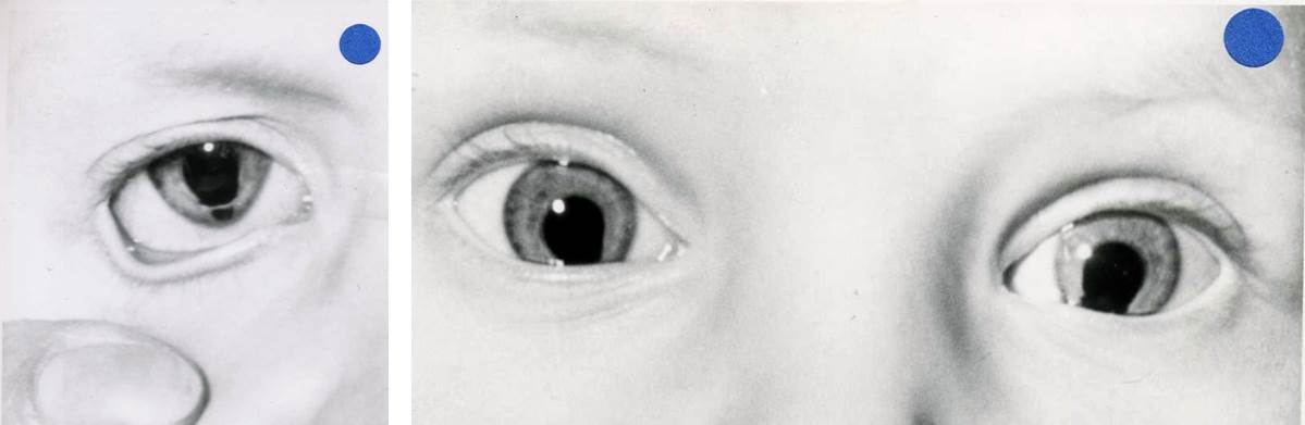 Coloboma – Clinical Eye Openers