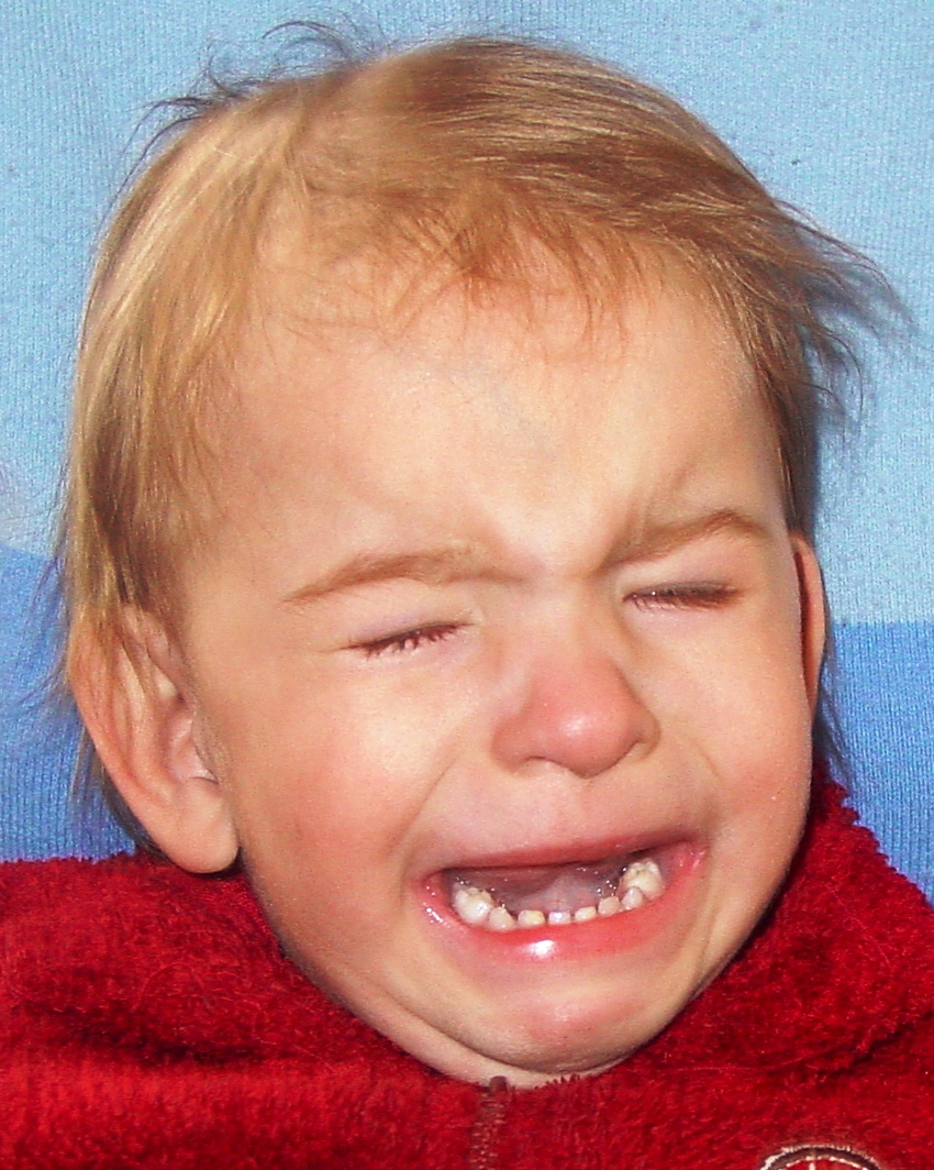 Facies Dysmorphic 03 (Rule out FAS or FASD) – Clinical Eye Openers