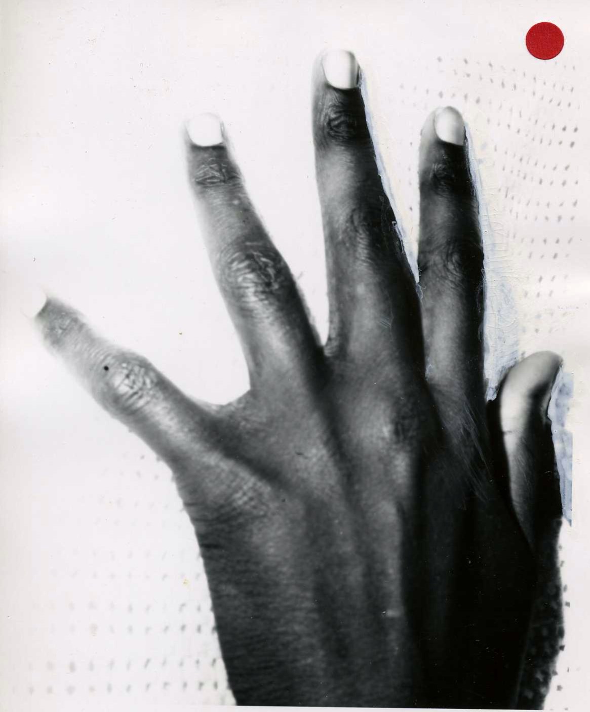 Arachnodactyly – Syndactyly – Marfan Syndrome? – Clinical Eye Openers