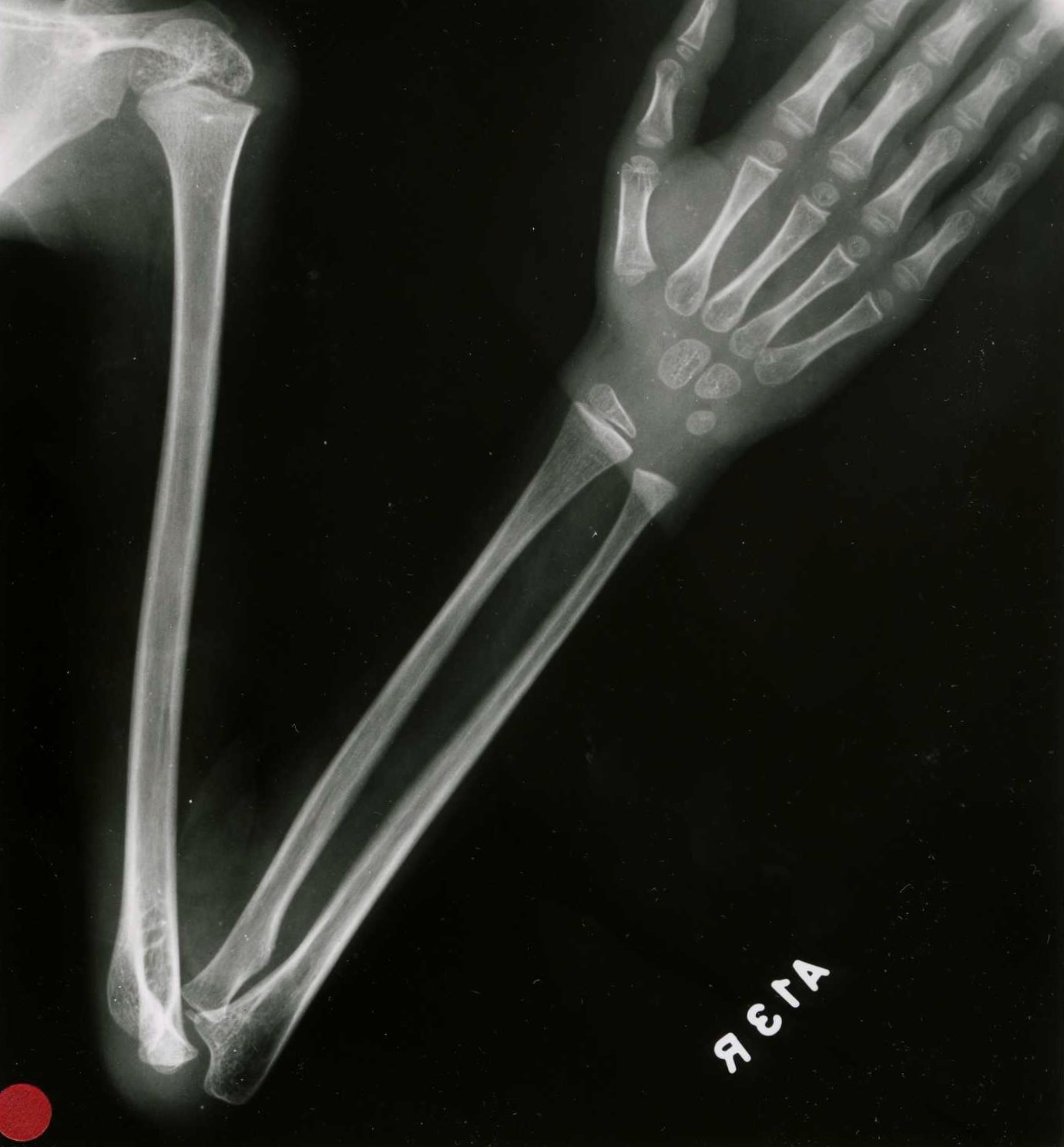 Gracile Long Bones (Dolicho) – Clinical Eye Openers