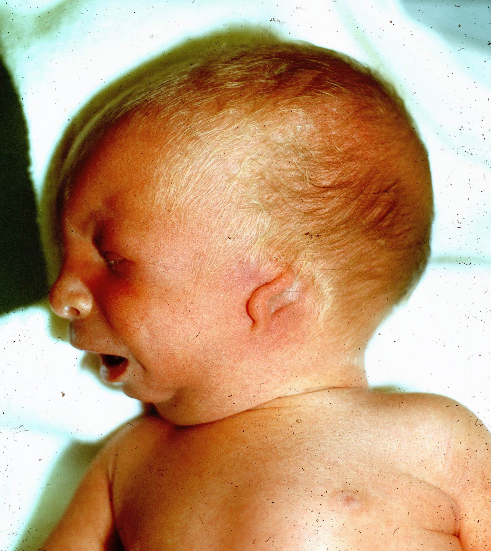 Microtia and … – Clinical Eye Openers