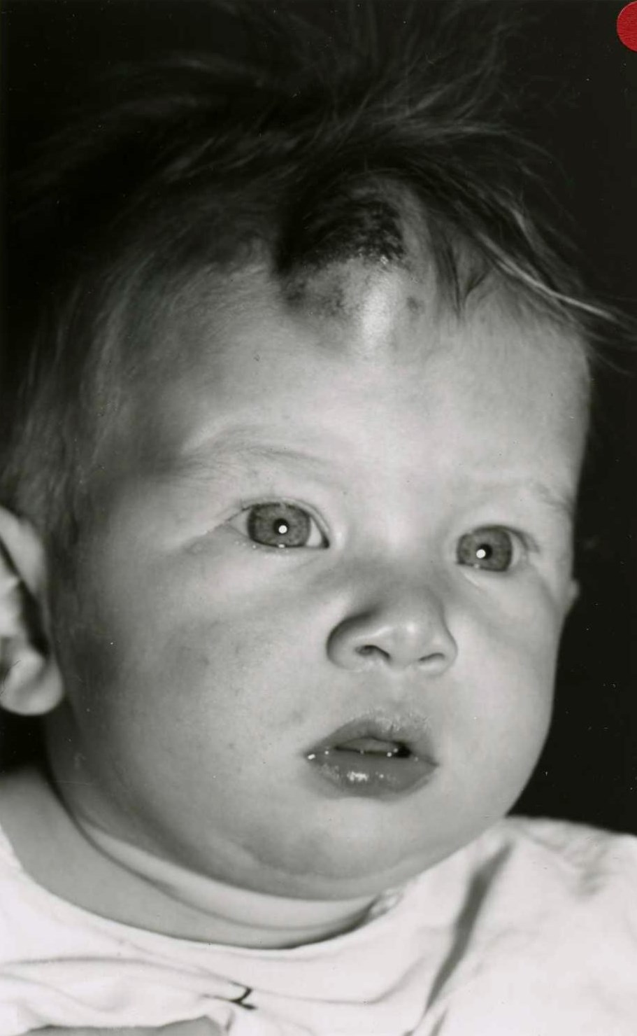 Angioma – Hemangioma – Clinical Eye Openers